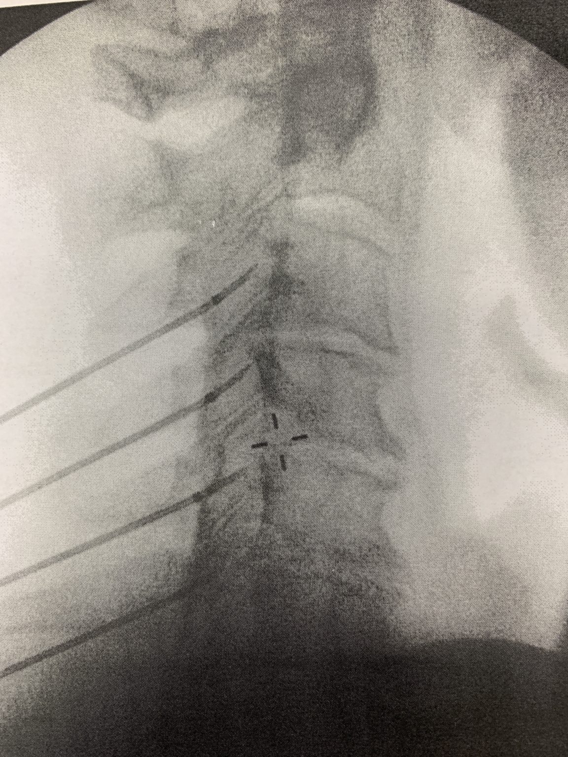 Radiofrequency Lesioning - Redding Pain Medicine